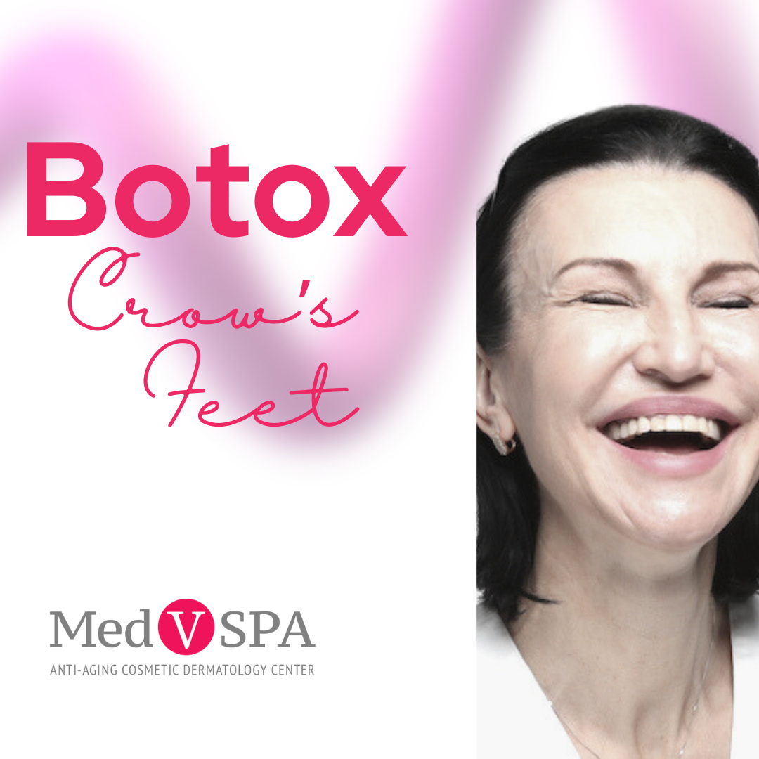 Botox for Crow's Feet: An Ultimate Guide. | MedVSPA